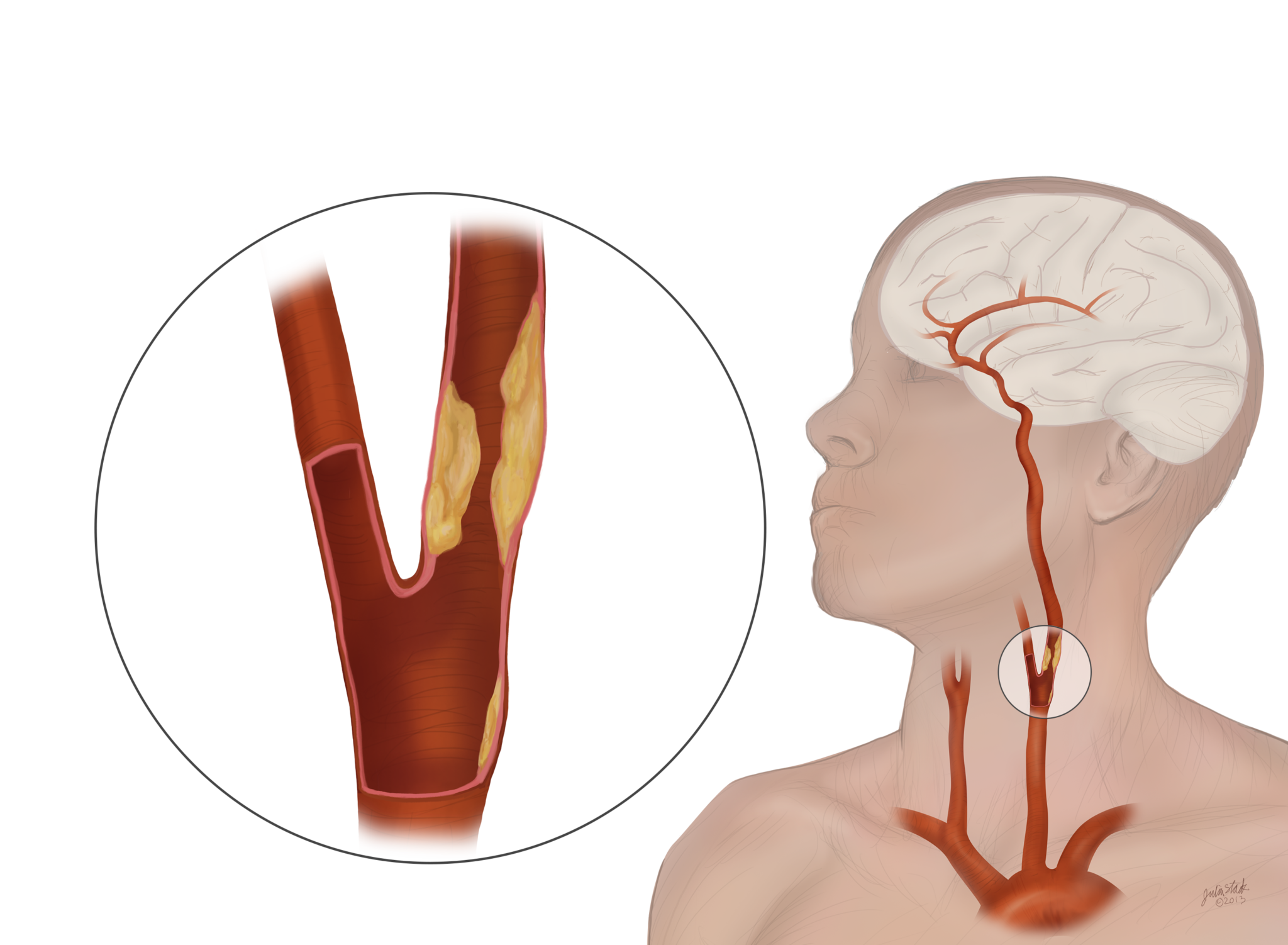 Transcarotid Artery Revascularization (TCAR) - Oaklawn Hospital