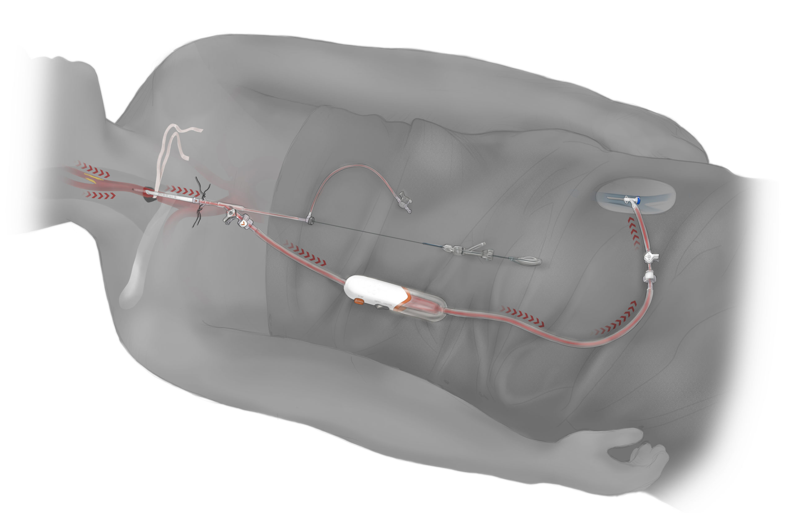 Transcarotid Artery Revascularization (TCAR) - Oaklawn Hospital